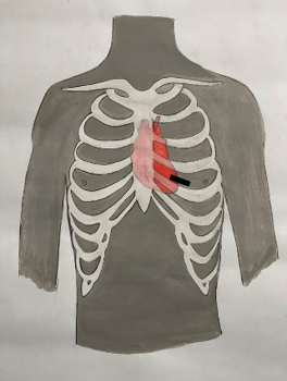 Minimal-invasive Bypass-Operation (TCRAT) - Klinikum Fulda