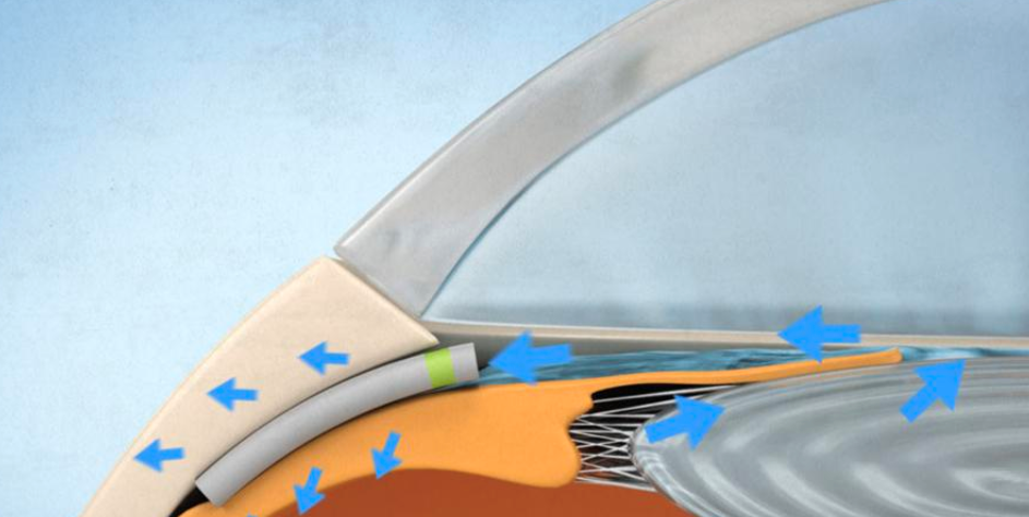 Glaukomchirurgie - Moderne minimalinvasive Glaukomchirurgie - Klinikum ...